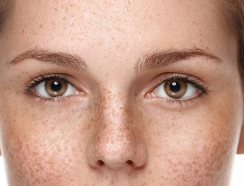 Does Hyperpigmentation Get Worse as You Age? Understanding This Common ...